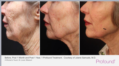 Volume Loss & Facial Contours - LifeScape Concierge Medical Practice